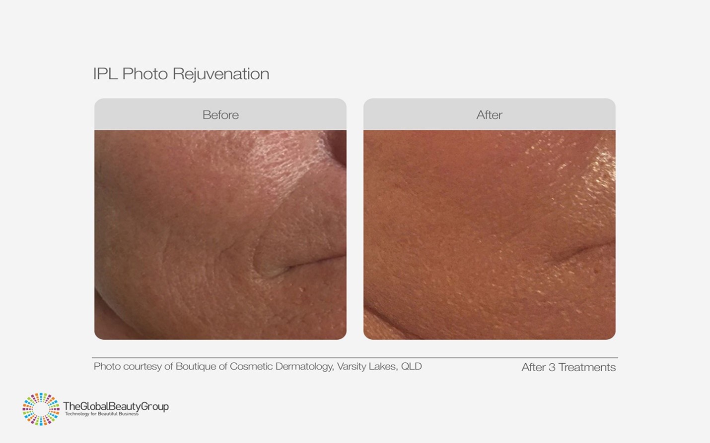 SuperLUX-IPL-Skin-Rejuvenation Facials – Lanaoncospa